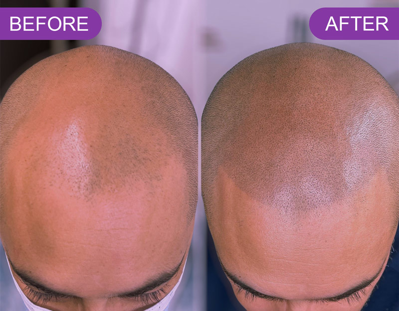 Scalp Micropigmentation: The Solution for Hair Loss in Kolkata | Truly ...